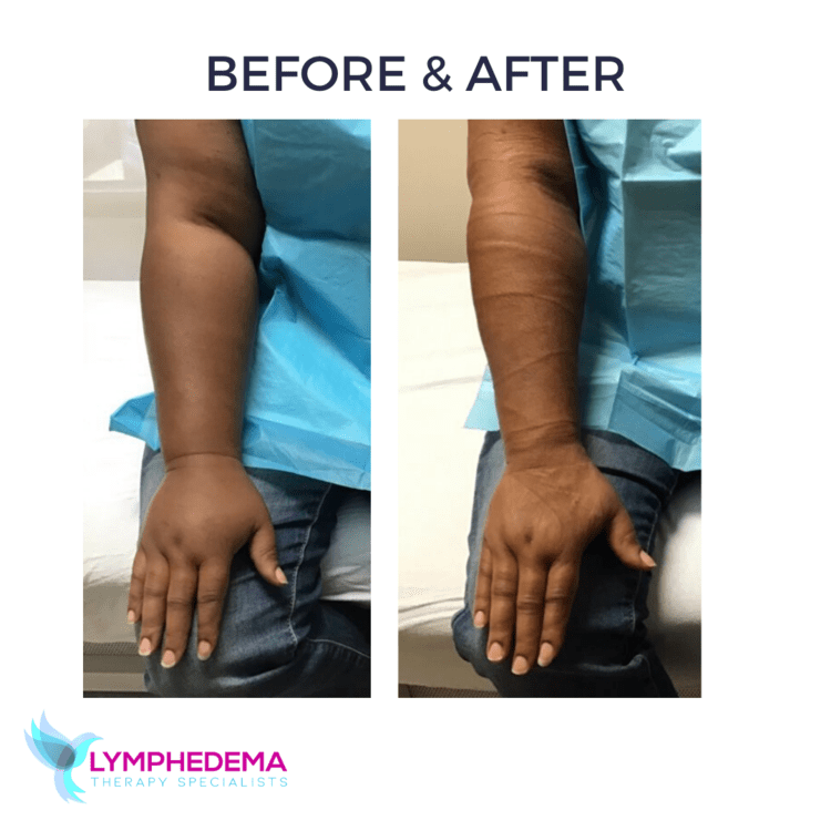 Photos | Lymphedema Therapy Specialists